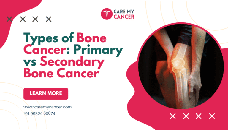Types of Bone Cancer: Primary vs Secondary Bone Cancer